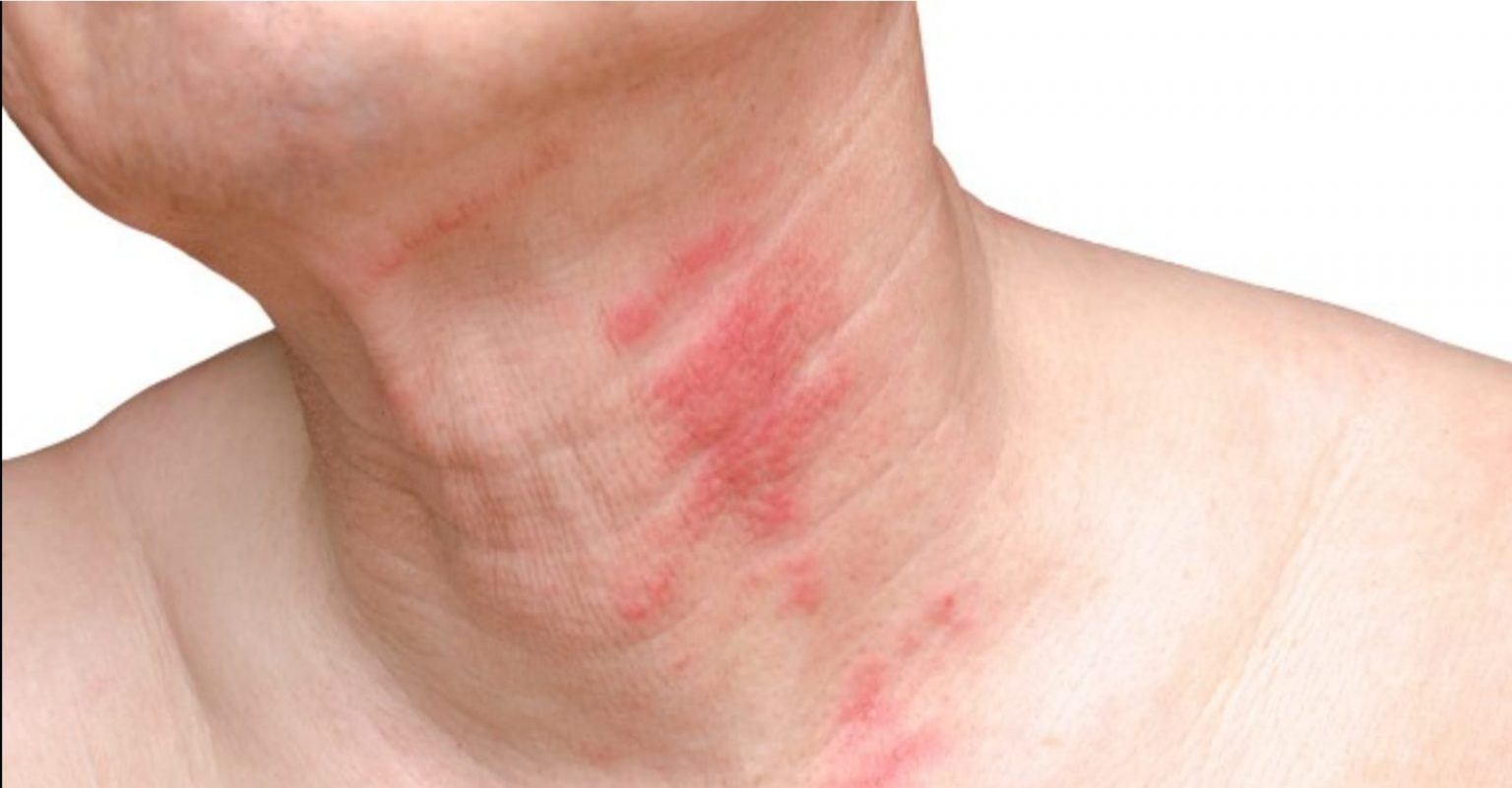 Apa Itu Dermatitis Eksim? – Beritalima.com
