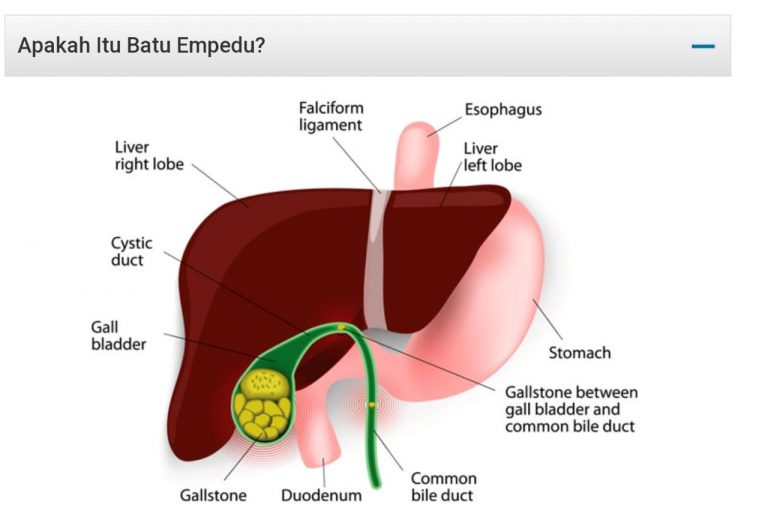 Batu Empedu, Bagaimana Menghadapinya? – Beritalima.com